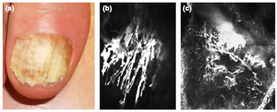 Emerging Optical Techniques for the Diagnosis of Onychomycosis