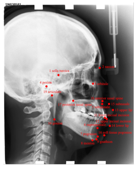 Automatic Cephalometric Landmark Detection on X-ray Images Using a Deep-Learning Method