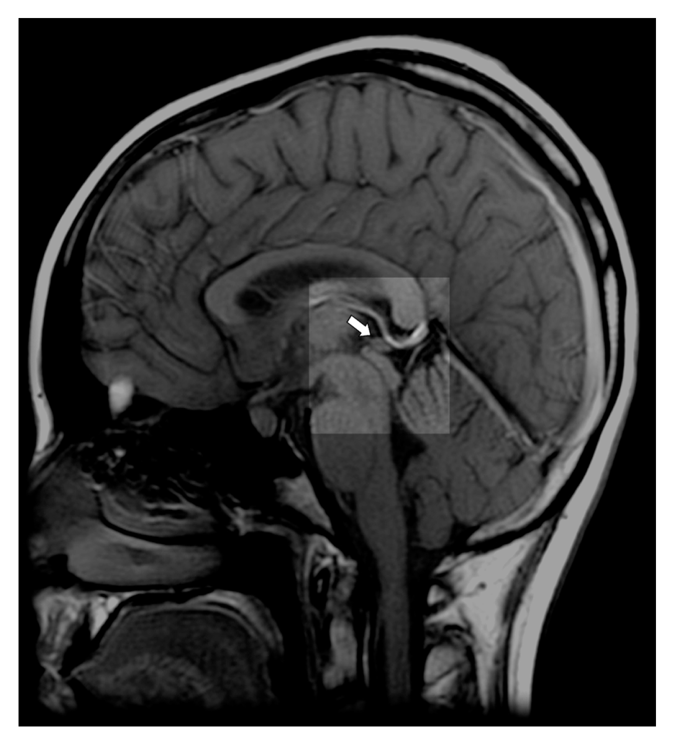 Pineal Gland Mri