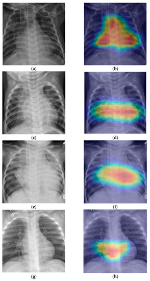 A Transfer Learning Method for Pneumonia Classification and Visualization