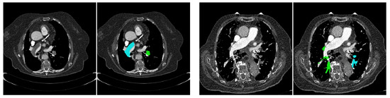 Computer Aided Detection of Pulmonary Embolism Using Multi-Slice Multi-Axial Segmentation
