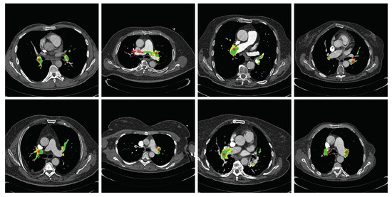 Computer Aided Detection of Pulmonary Embolism Using Multi-Slice Multi-Axial Segmentation