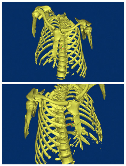 Accident Reconstruction of Damaged Human Body Using MDCT and Computer ...