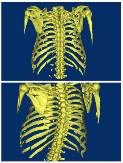 Accident Reconstruction of Damaged Human Body Using MDCT and Computer ...