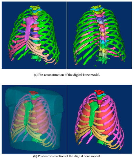Accident Reconstruction of Damaged Human Body Using MDCT and Computer ...