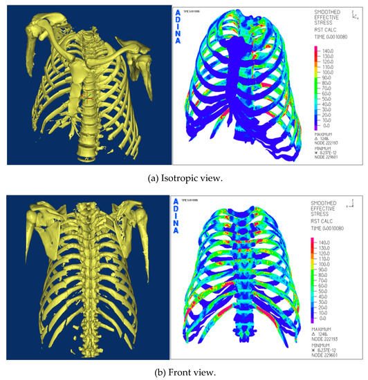 Accident Reconstruction of Damaged Human Body Using MDCT and Computer ...