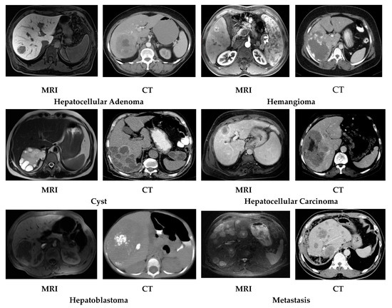 Machine-Learning Based Hybrid-Feature Analysis for Liver Cancer ...