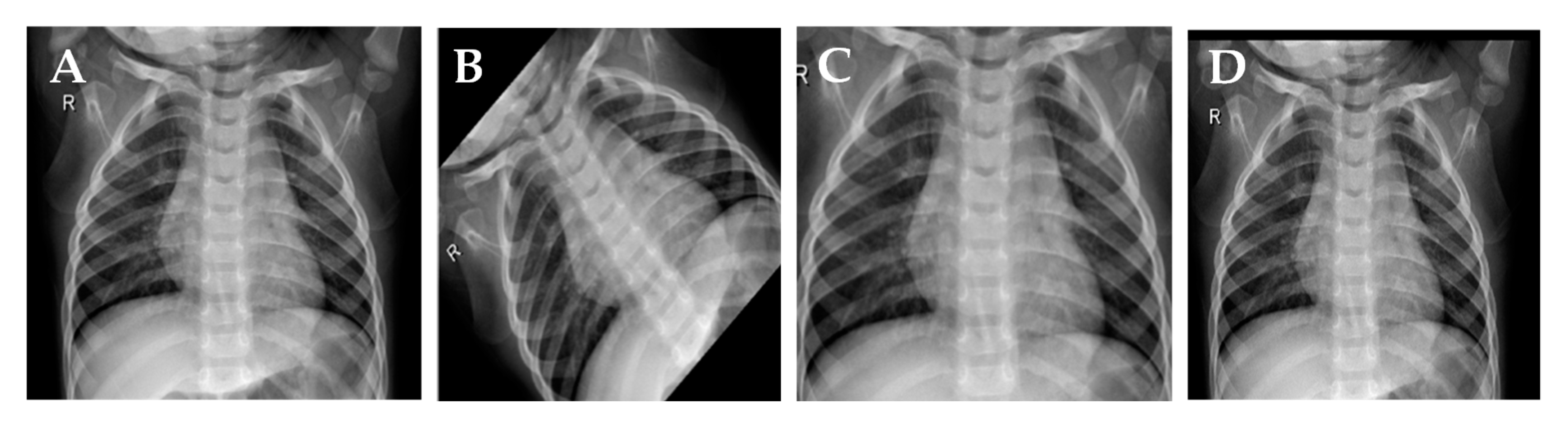Transfer Learning with Deep Convolutional Neural Network (CNN) for Pneumonia Detection Using ...