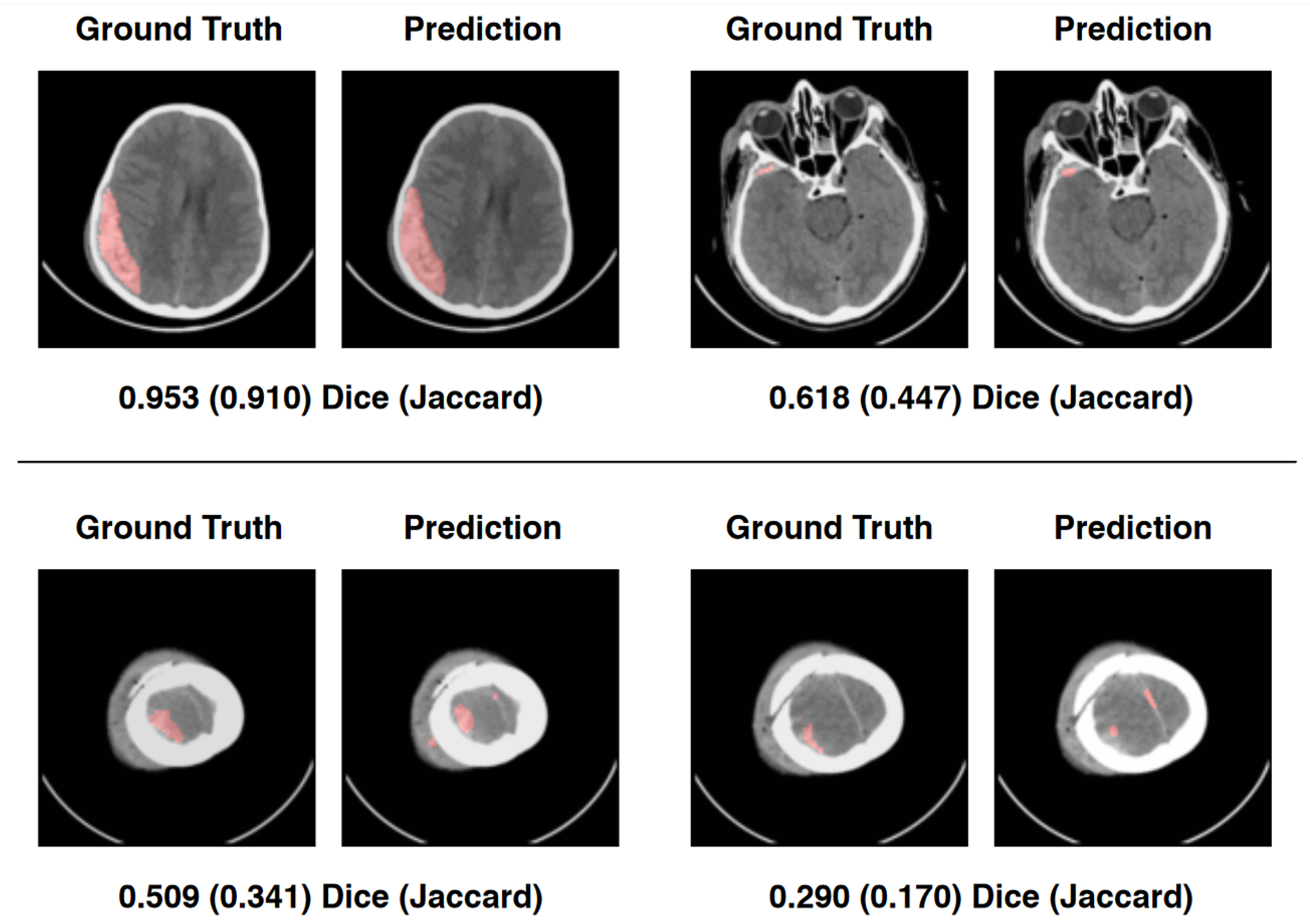 Segmentation of Intracranial Hemorrhage Using Semi-Supervised Multi-Task Attention-Based U-Net