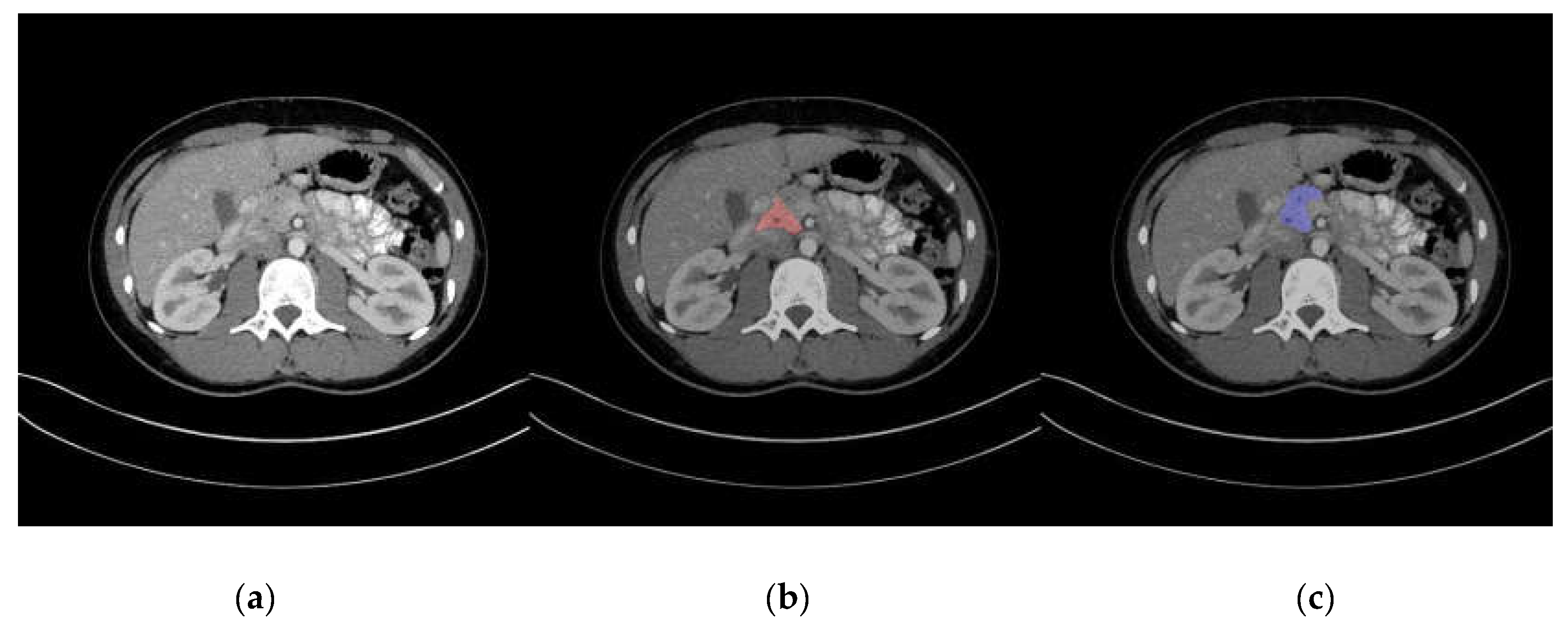 Automatic Pancreas Segmentation Using Coarse-Scaled 2D Model of Deep Learning: Usefulness of ...