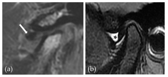 Comparison of the Usefulness of CBCT and MRI in TMD Patients According ...