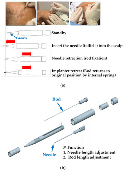 Needle Transportable Semi-Automatic Hair Follicle Implanter and Image ...