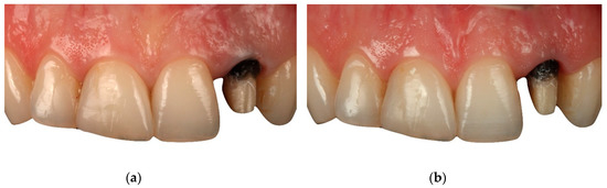 Influence of Angulation in Cervical Prosthetic Emergences Relative to ...