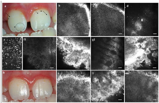 Real Time In Vivo Confocal Microscopic Analysis of the Enamel Remineralization by Casein ...