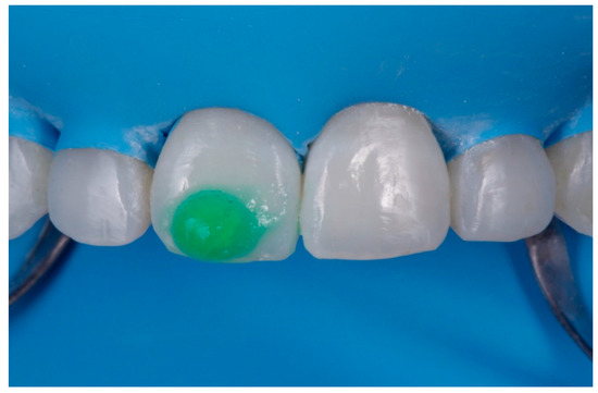 Dental Treatment of White Spots and a Description of the Technique and ...