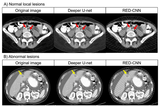 Simulation Study of Low-Dose Sparse-Sampling CT with Deep Learning ...