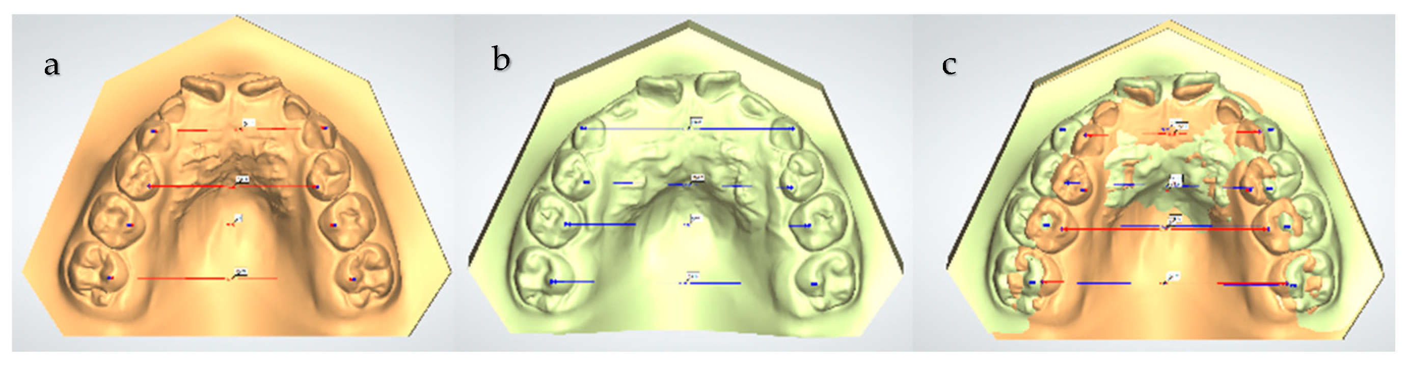 Three-Dimensional Evaluation of Slow Maxillary Expansion with Leaf ...
