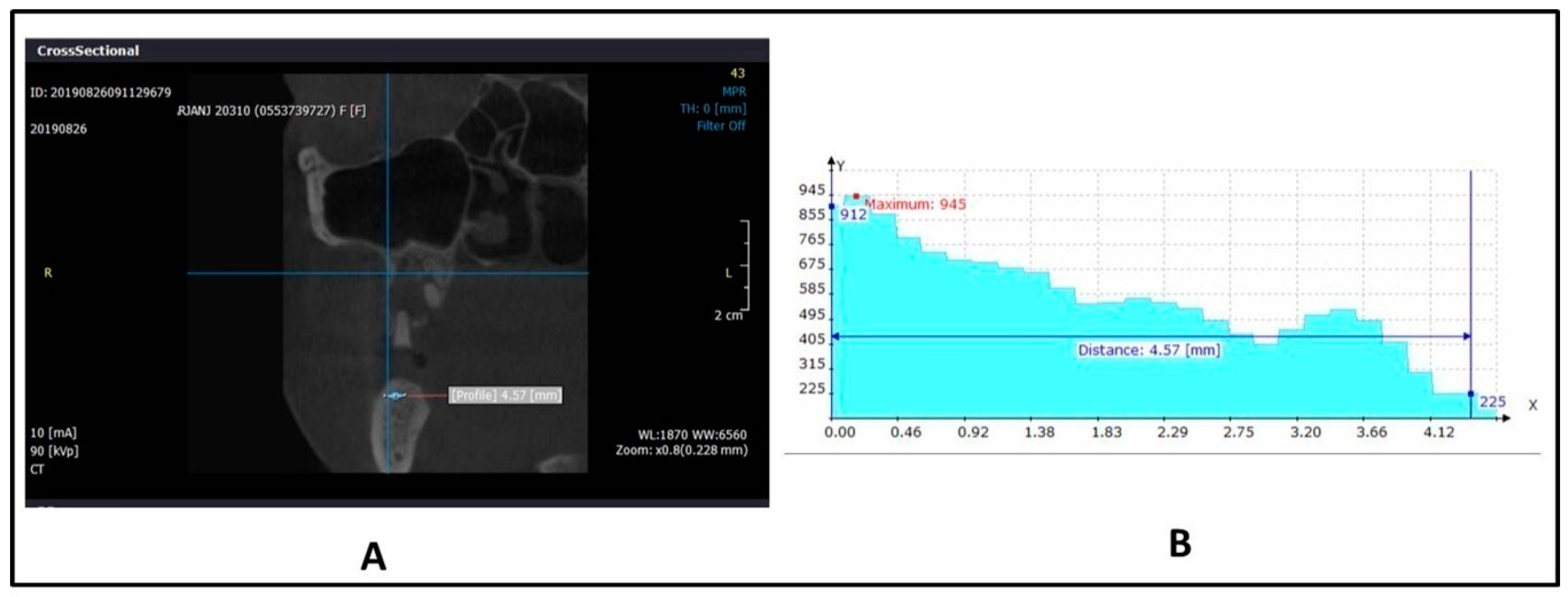 Comparing the Diagnostic Accuracy of CBCT Grayscale Values with DXA ...