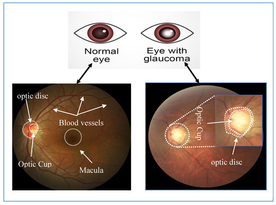 Deep Learning for Optic Disc Segmentation and Glaucoma Diagnosis on ...