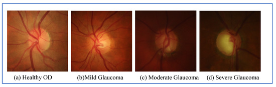 Deep Learning for Optic Disc Segmentation and Glaucoma Diagnosis on ...