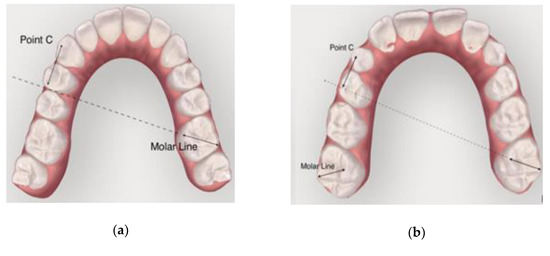 Mesial Rotation of the Upper First Molar: Association with Anterior ...
