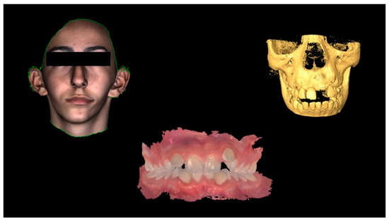 How to Obtain an Orthodontic Virtual Patient through Superimposition of ...