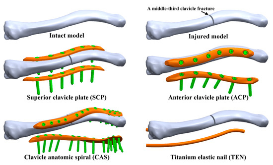 A Biomechanical Study of Various Fixation Strategies for the Treatment ...