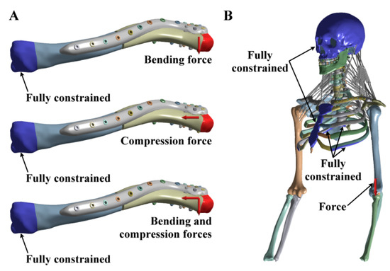 A Biomechanical Study of Various Fixation Strategies for the Treatment ...