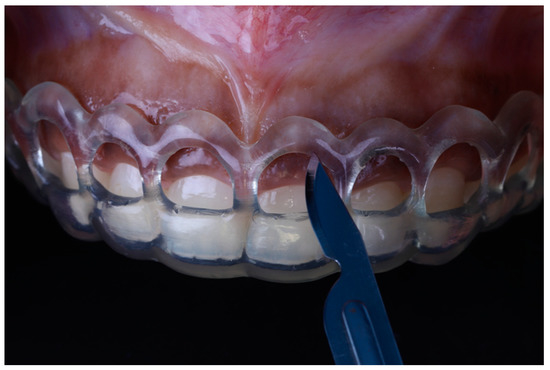 3D-Printed Surgical Guide for Crown Lengthening Based on Cone Beam ...