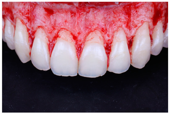 3D-Printed Surgical Guide for Crown Lengthening Based on Cone Beam ...