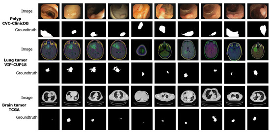 Enhancing U-Net with Spatial-Channel Attention Gate for Abnormal Tissue ...