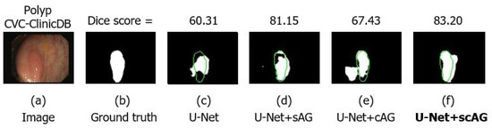 Enhancing U-Net with Spatial-Channel Attention Gate for Abnormal Tissue ...