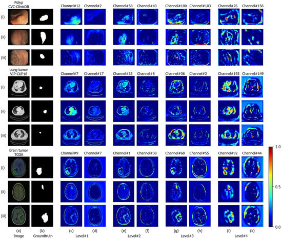 Enhancing U-Net with Spatial-Channel Attention Gate for Abnormal Tissue ...