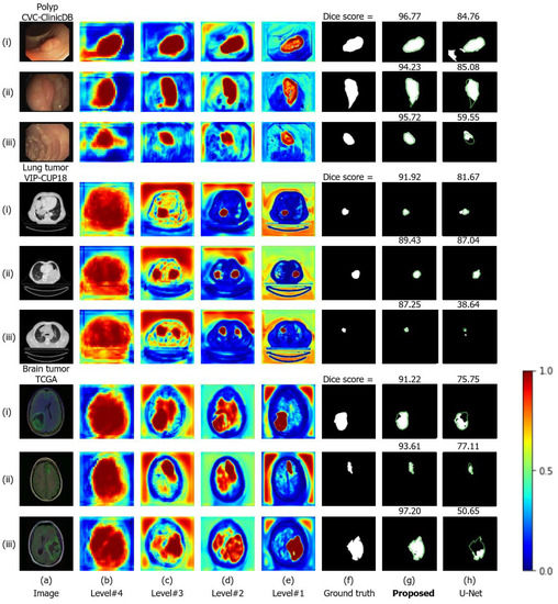 Enhancing U-Net with Spatial-Channel Attention Gate for Abnormal Tissue ...