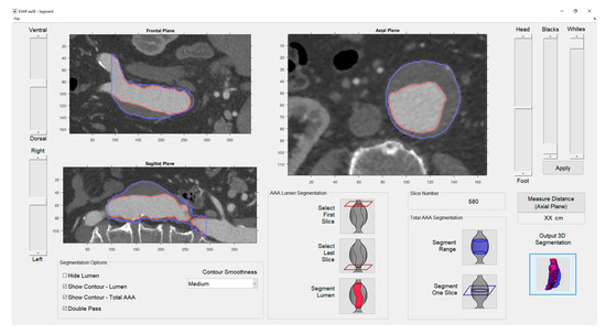 EVAR-eaSE: An Easy-to-Use Software for Planning Sac Embolization in ...