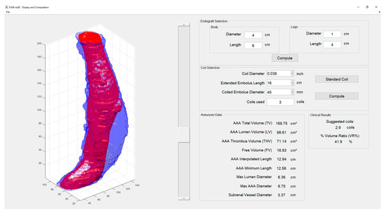 EVAR-eaSE: An Easy-to-Use Software for Planning Sac Embolization in ...