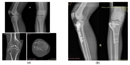 Liquid Nitrogen Efficiency in Treatment of Giant Cell Tumor of Bone and ...