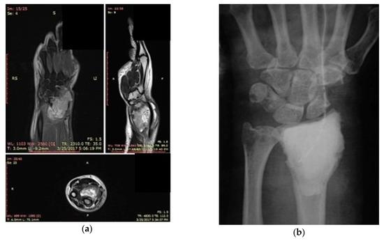 Liquid Nitrogen Efficiency in Treatment of Giant Cell Tumor of Bone and ...