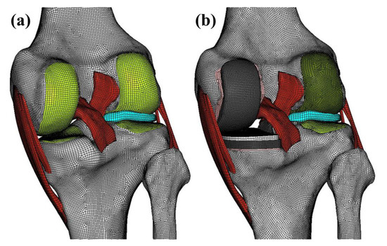 Biomechanical Effect of Various Tibial Bearing Materials in Uni ...