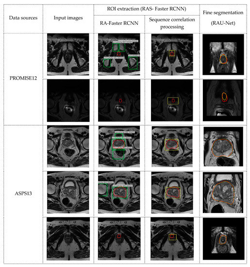 CDA-Net for Automatic Prostate Segmentation in MR Images