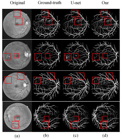 MRU-NET: A U-Shaped Network for Retinal Vessel Segmentation