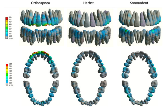 Comparison of the Effects Caused by Three Different Mandibular ...