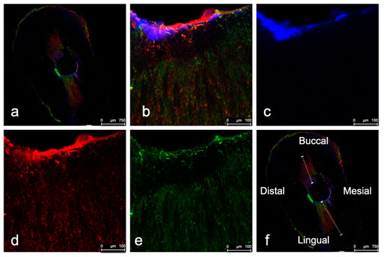 The Invasion of Bacterial Biofilms into the Dentinal Tubules of ...