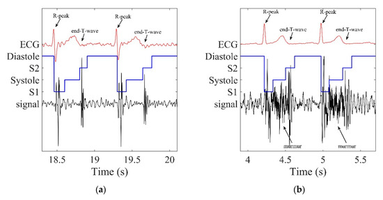 Temporal Convolutional Network Connected with an Anti-Arrhythmia Hidden Semi-Markov Model for ...