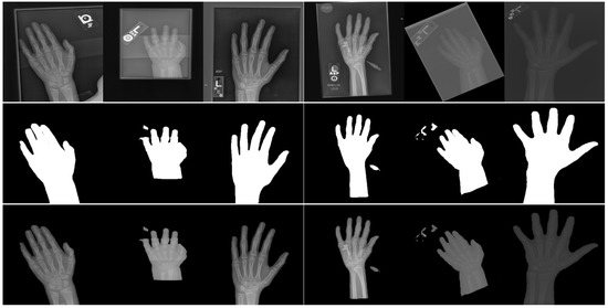 Automated Bone Age Assessment with Image Registration Using Hand X-ray ...