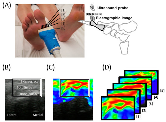 Using Elastographic Ultrasound to Assess Plantar Tissue Stiffness after ...