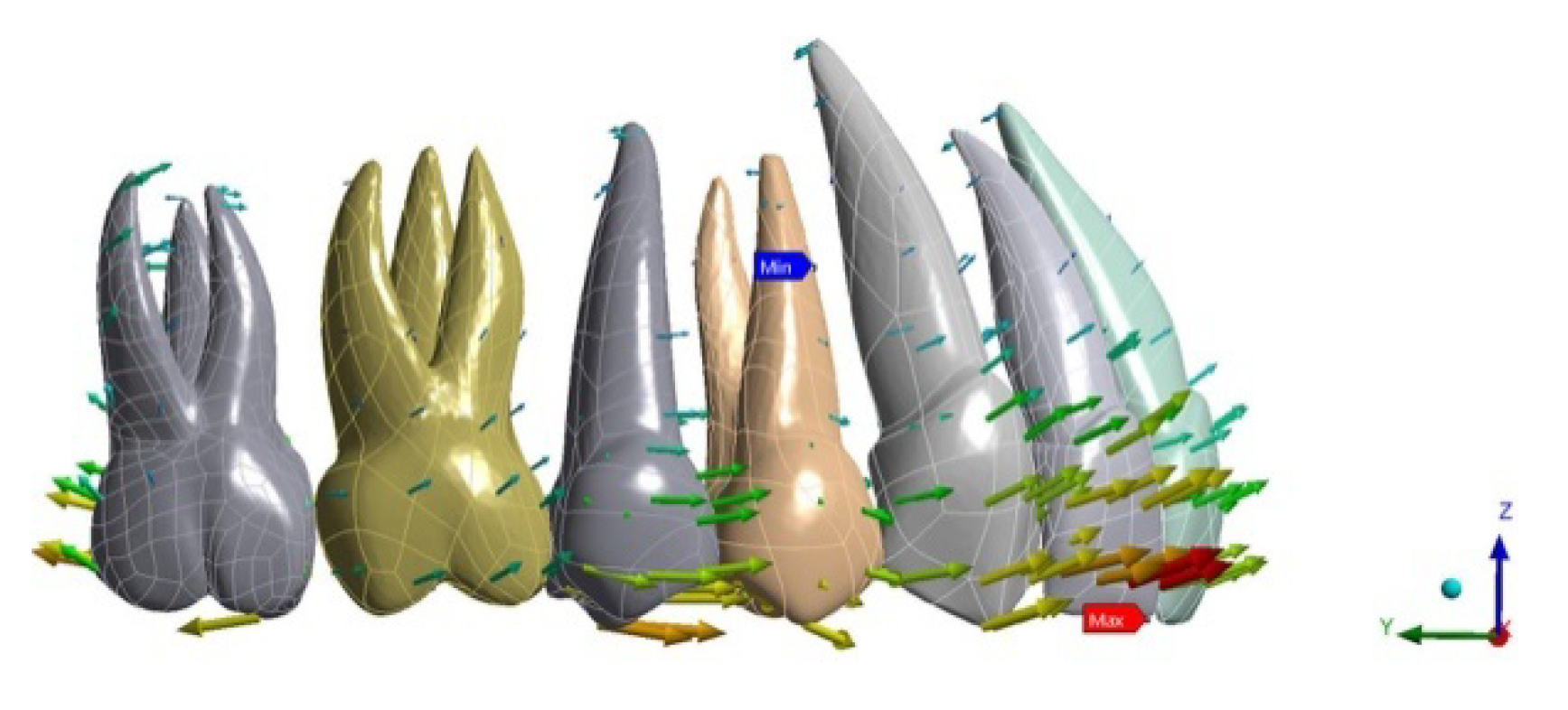Upper Second Molar Distalization with Clear Aligners: A Finite Element ...