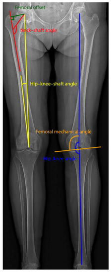 Determination of Leg Alignment in Hip Osteoarthritis Patients with the ...