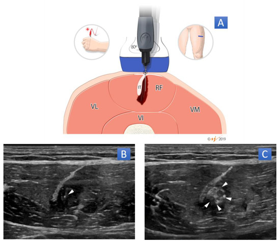 Ultrasound-Guided Percutaneous Needle Electrolysis and Rehab and ...