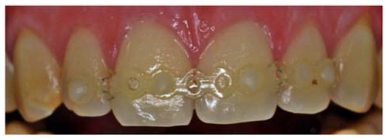 Assessment of a Power Chain as a New Dental Trauma Splint and Its ...